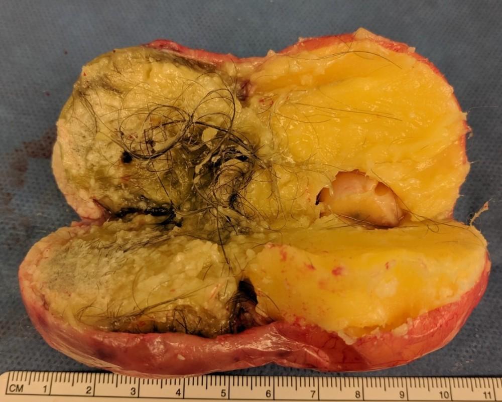 Cara Kecutkan Cyst Tanpa Pembedahan | Nina Salleh